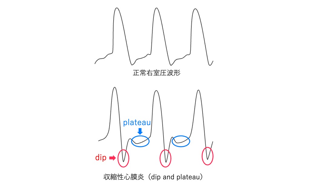 【循環器疾患】心膜疾患（急性心膜炎・収縮性心膜炎・心タンポナーデ）を図解で総整理
